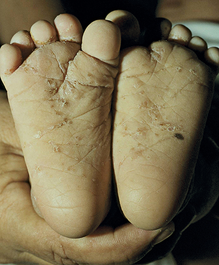 Vid klåda, tänk alltid på skabb! – Läkartidningen